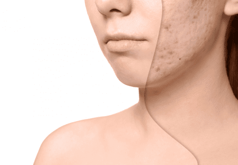Acne Scar Treatment Leeds | Medifine Skin Clinic