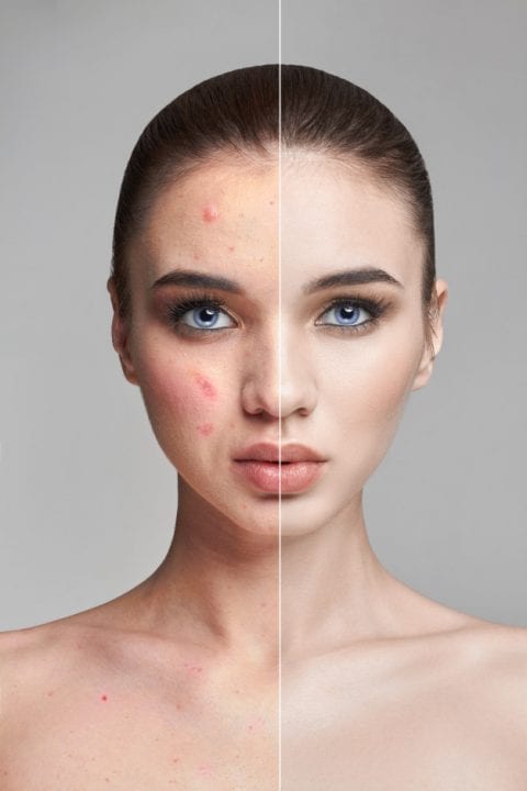 HOW TO DEAL WITH A BAD SKIN DAY | Medifine Skin Clinic