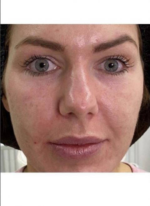 PRP Filler – New Treatment | Medifine Skin Clinic